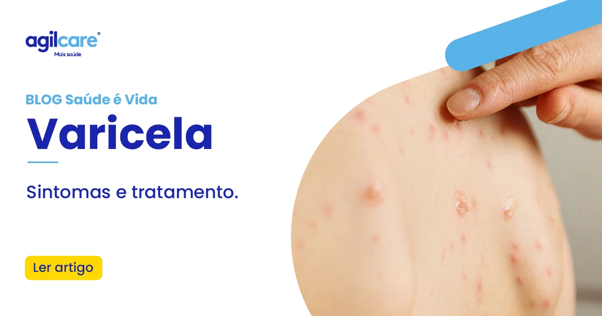 Varicela: sintomas e tratamento - Agilcare | Plano de Saúde + Plano Dental